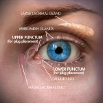 Punctal Occlusion - Advanced Eyecare of Chino Optometry
